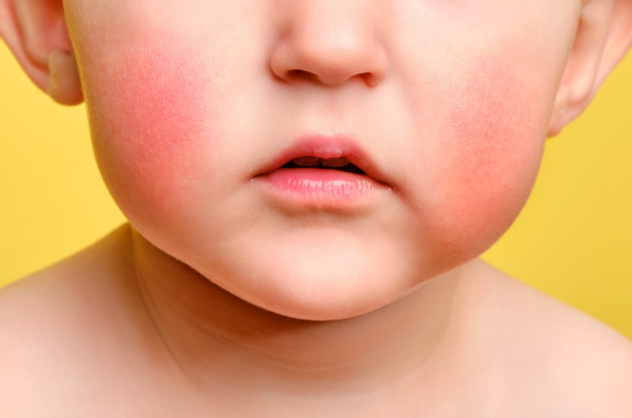 Epidémie d’infections à parvovirus en France : vigilance en particulier ...